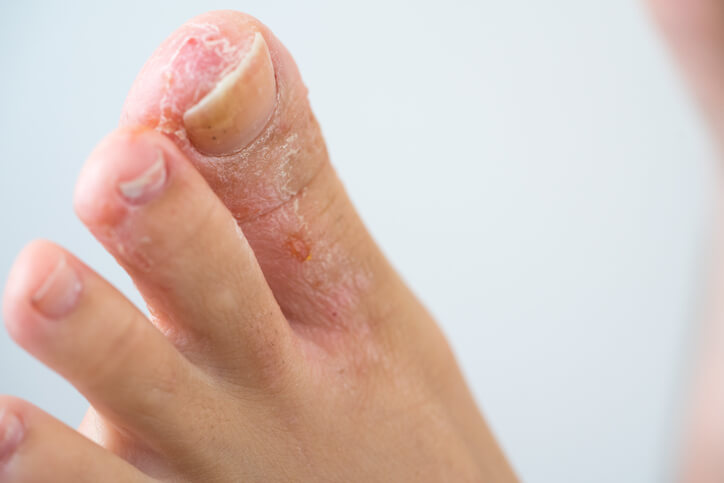 Tinea Skin Infections – ResearchTrials.org