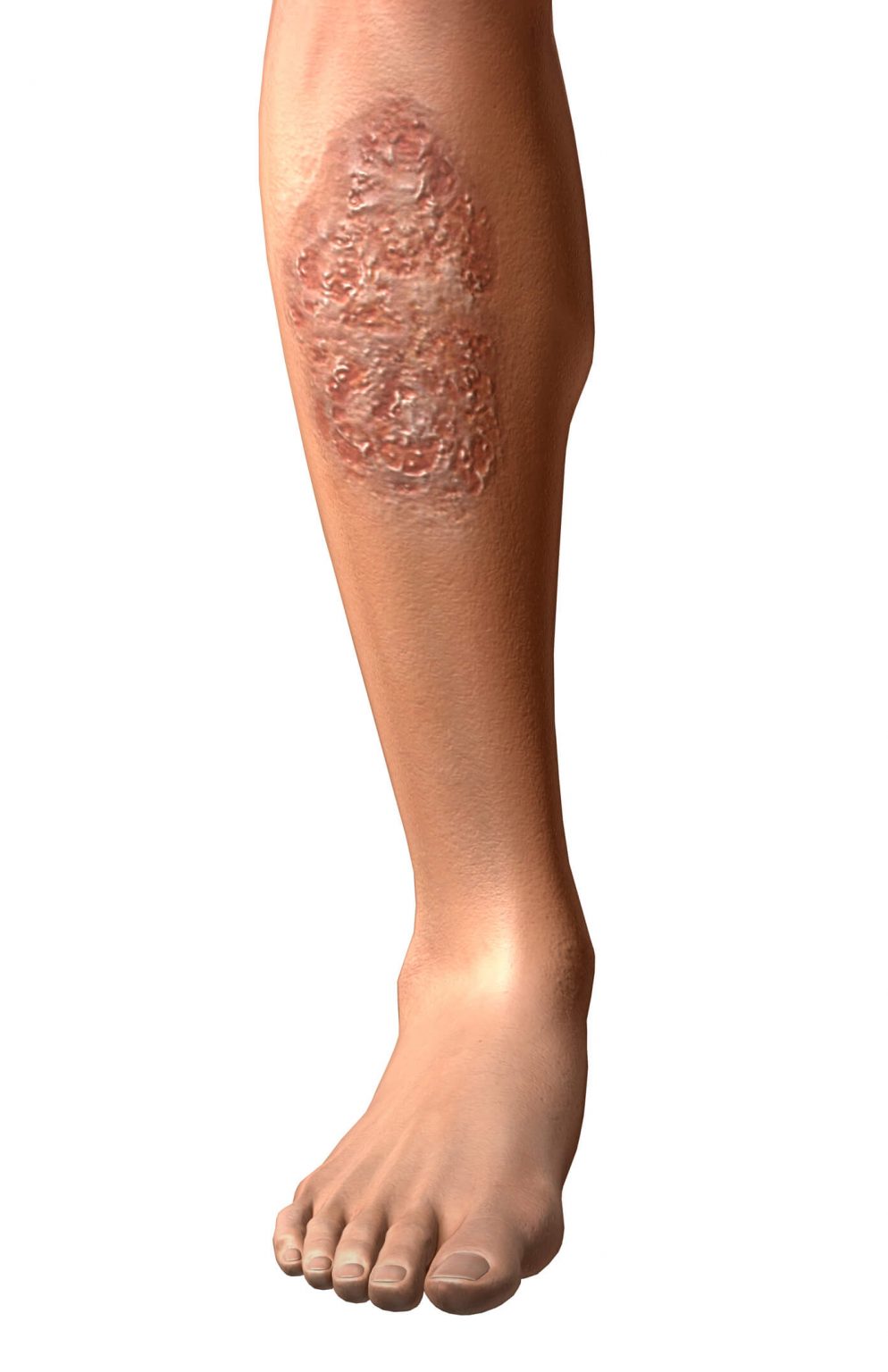 Pyoderma Gangrenosum – ResearchTrials.org