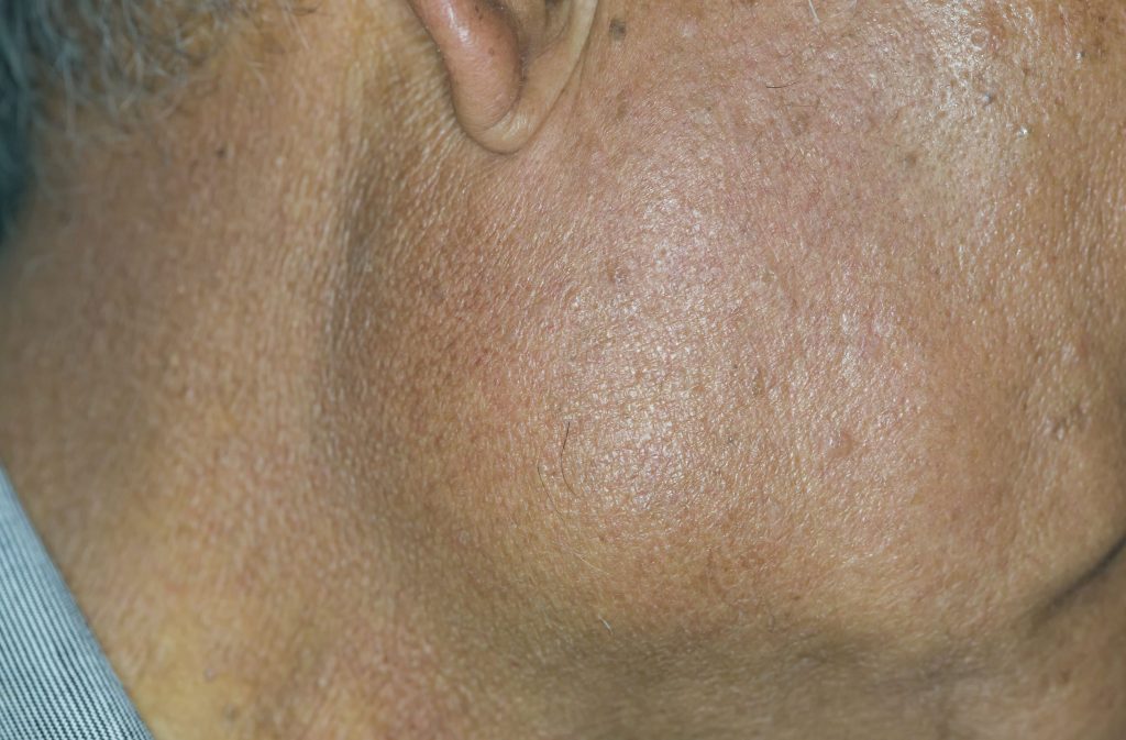 Masseter Muscle Hypertrophy – ResearchTrials.org