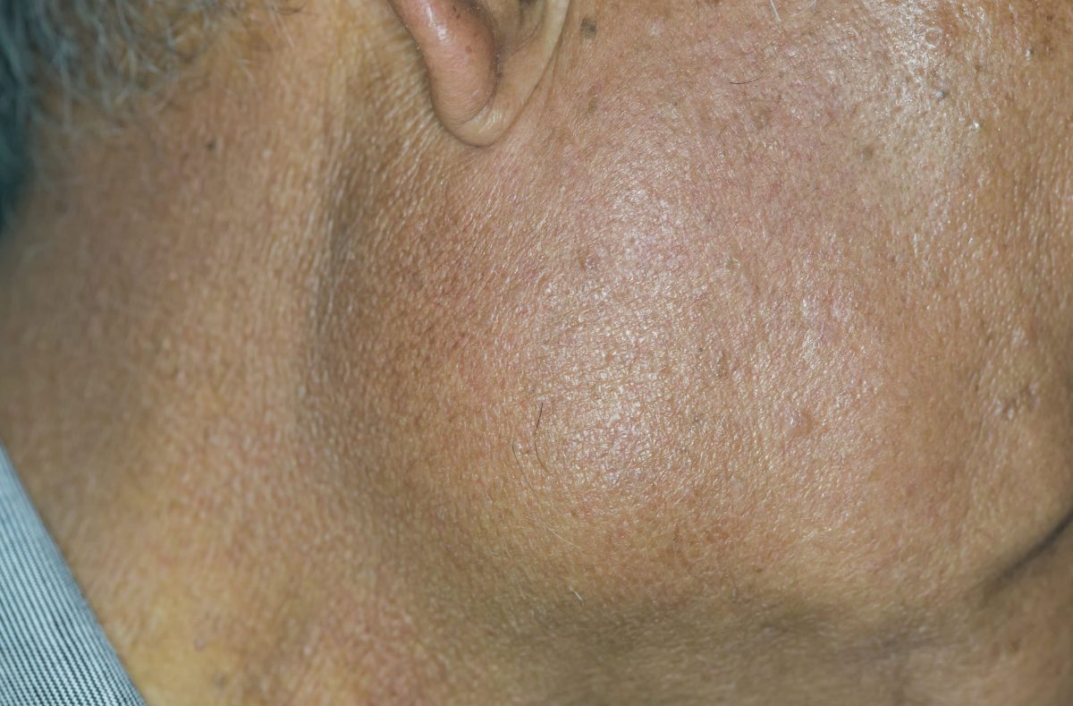 Masseter Muscle Hypertrophy – ResearchTrials.org Masseter Muscle Hypertrophy – ResearchTrials.org