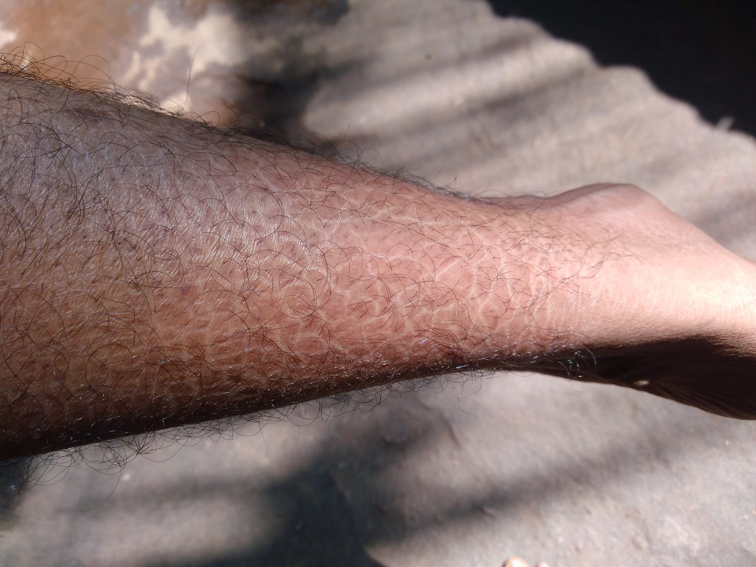 Severe Ichthyosis Vulgaris